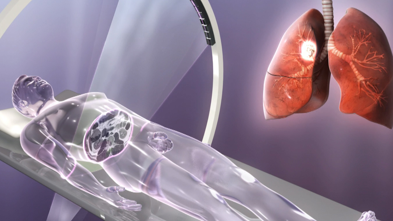 Lung Carcinoma Animation - CAST PHARMA